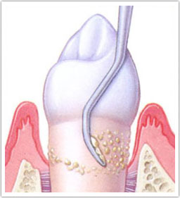 Root Planing Champaign IL, Tooth Scaling Charleston, Dental Deep Clean
